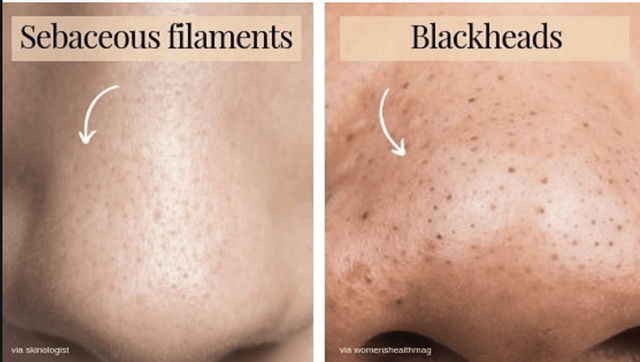 Sebaceous Filaments