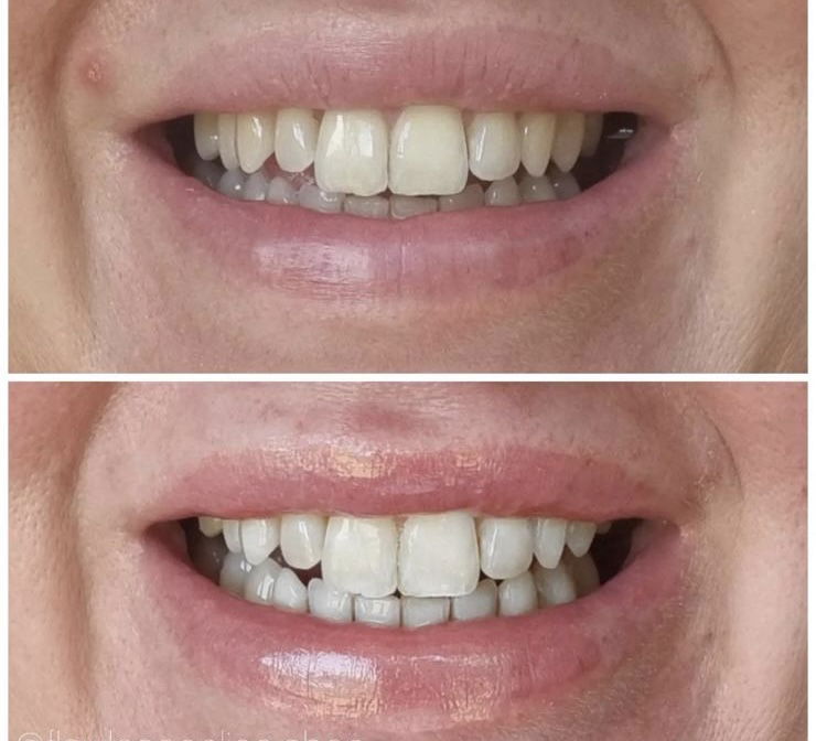 Enhance Your Smile with the Teeth Whitening Pen – Icy Bear Dental