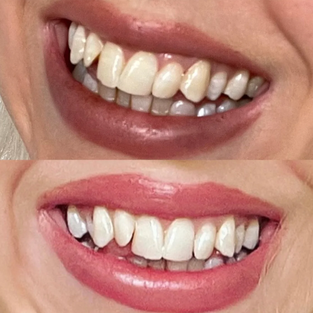 Enhance Your Smile with the Teeth Whitening Pen – Icy Bear Dental